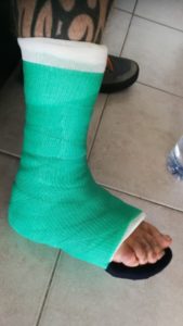 Fuss im Gips | Diagnose Knochenbruch | allmountain.ch